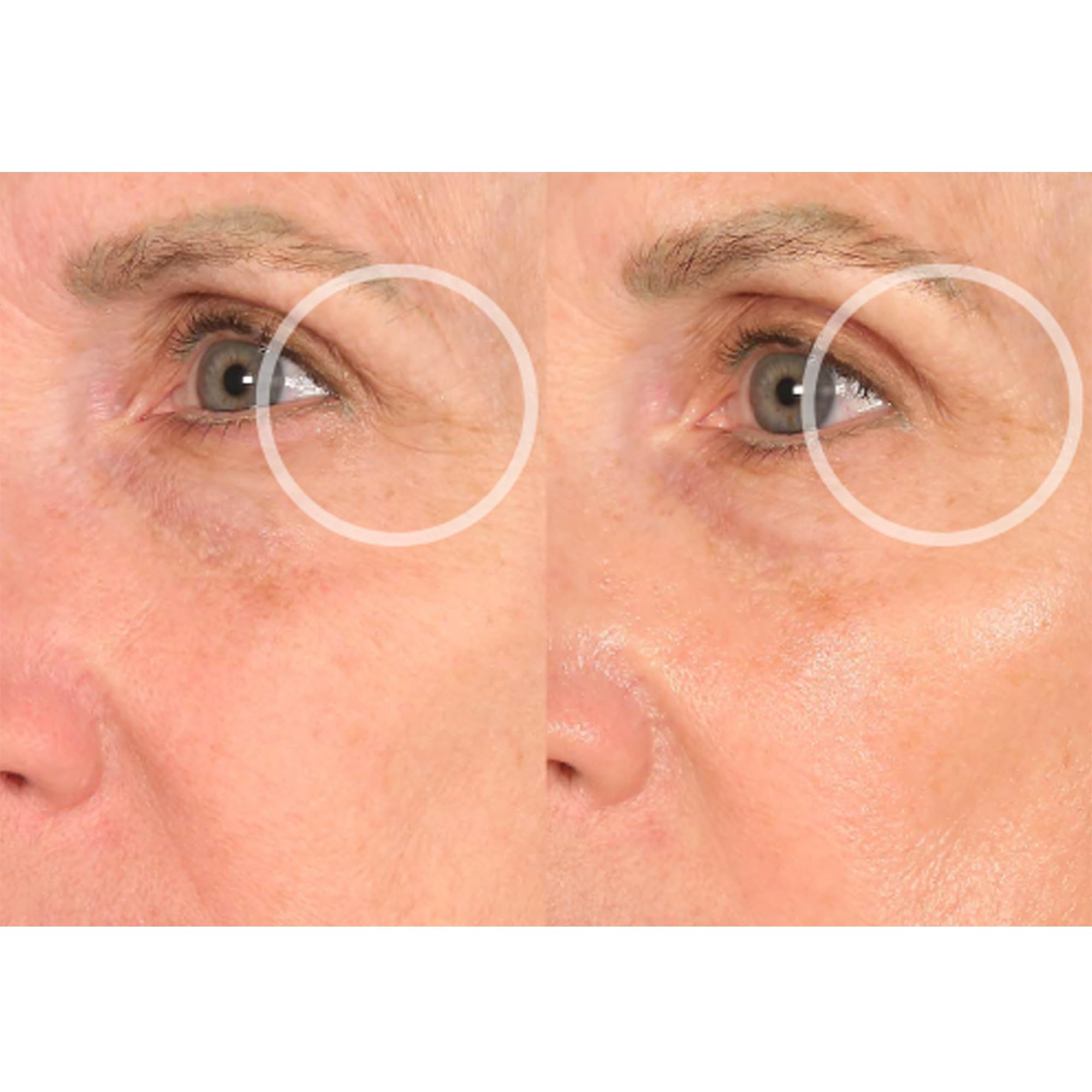 SiO Beauty FaceLift - Reusable Anti-Wrinkle Patches for Neck, Forehead, Eye & Smile - Overnight Smoothing Silicone for Fine Lines, Wrinkles, and Aging