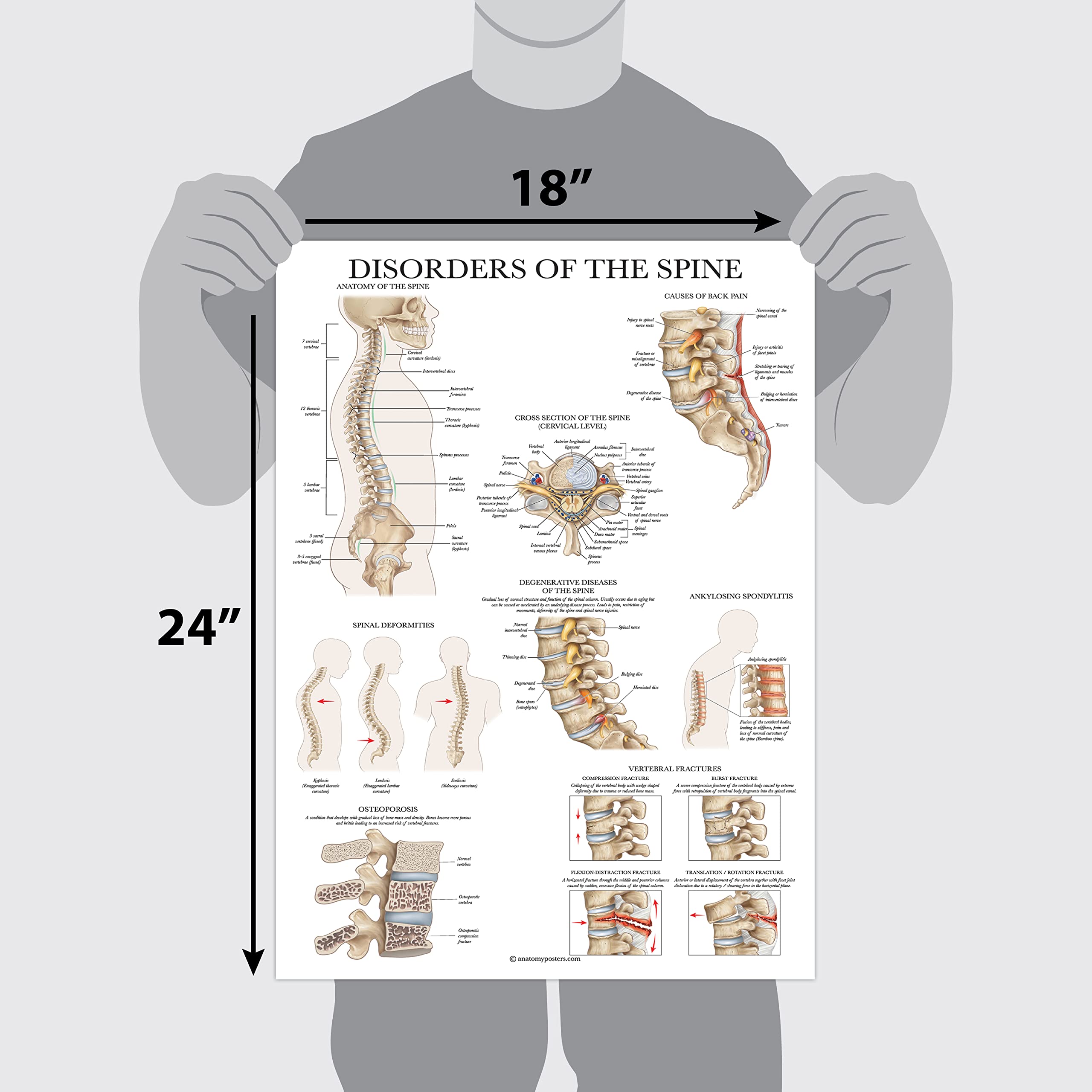 Palace Learning Disorders of the Spine Anatomy Poster - Laminated Spinal Disorders Anatomical Chart - 18" x 24"