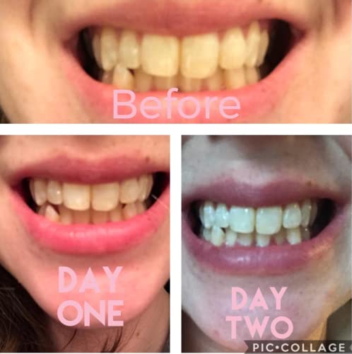 Smile Titan Teeth Whitening Kit, Teeth Whitening Gel (4) with 5X LED Accelerator Light and Tray Teeth Whitener