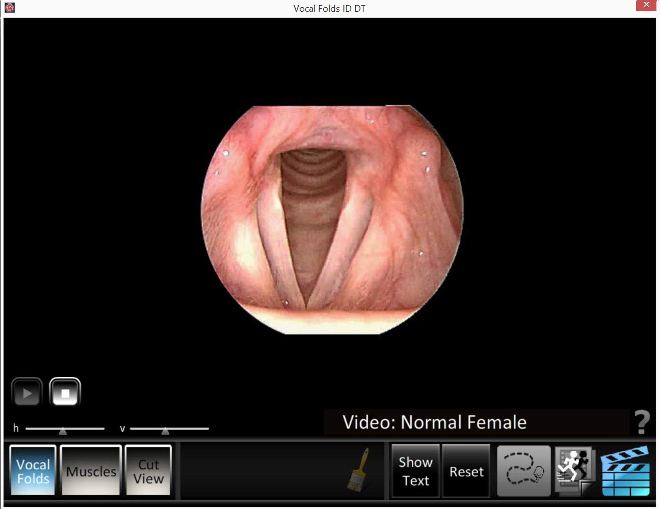 Vocal Parts, Pharynx & Larynx Anatomical Chart with Software Larynx and Vocal Fold ID Speech Language Pathology, SLP, Singing