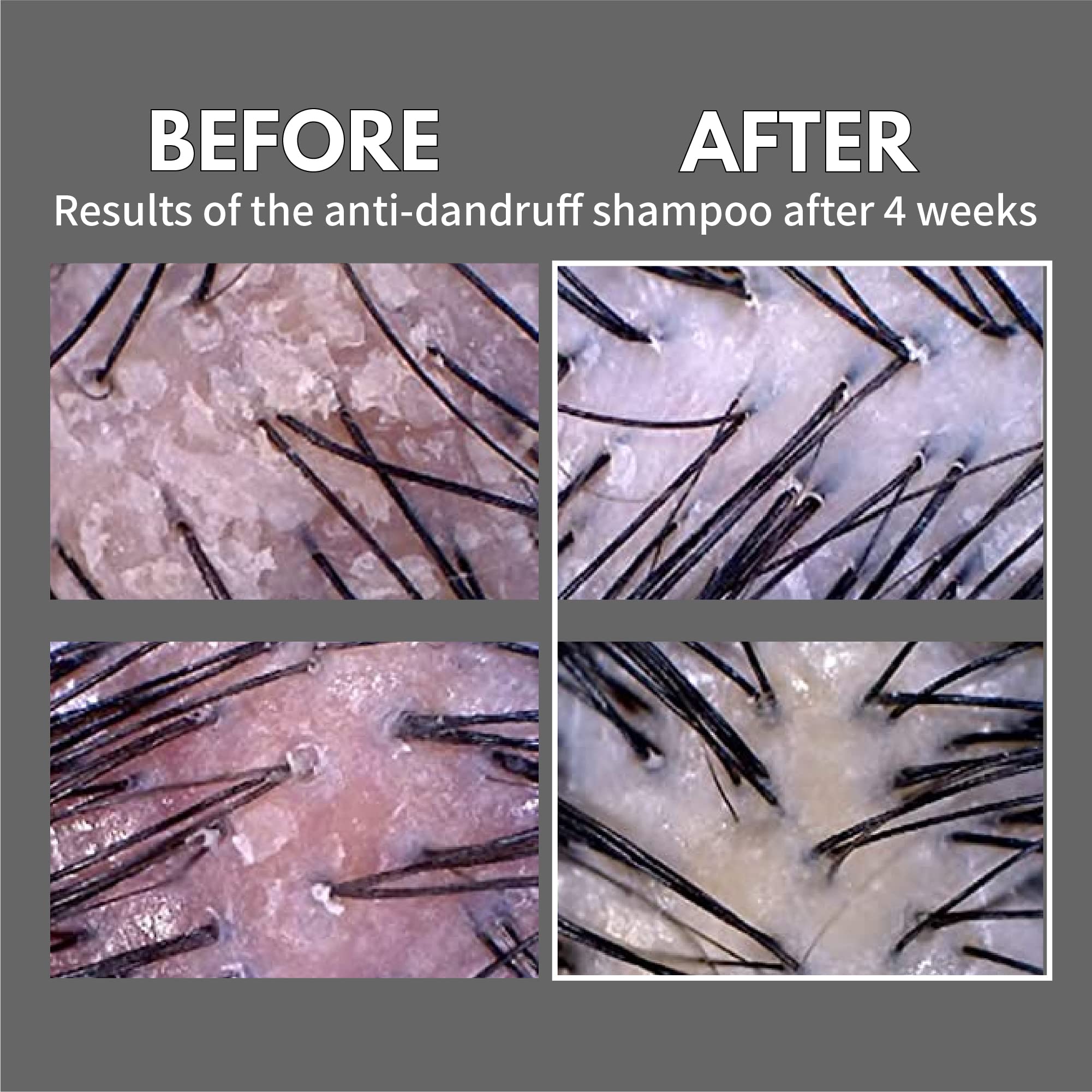 LA'DOR Anti-Dandruff Shampoo (16.9 fl.oz.) - For Oily Scalp with Dandruff, Gently Cleanses Away Dead Skin Cells, Alleviates Itching and Irritation LADOR