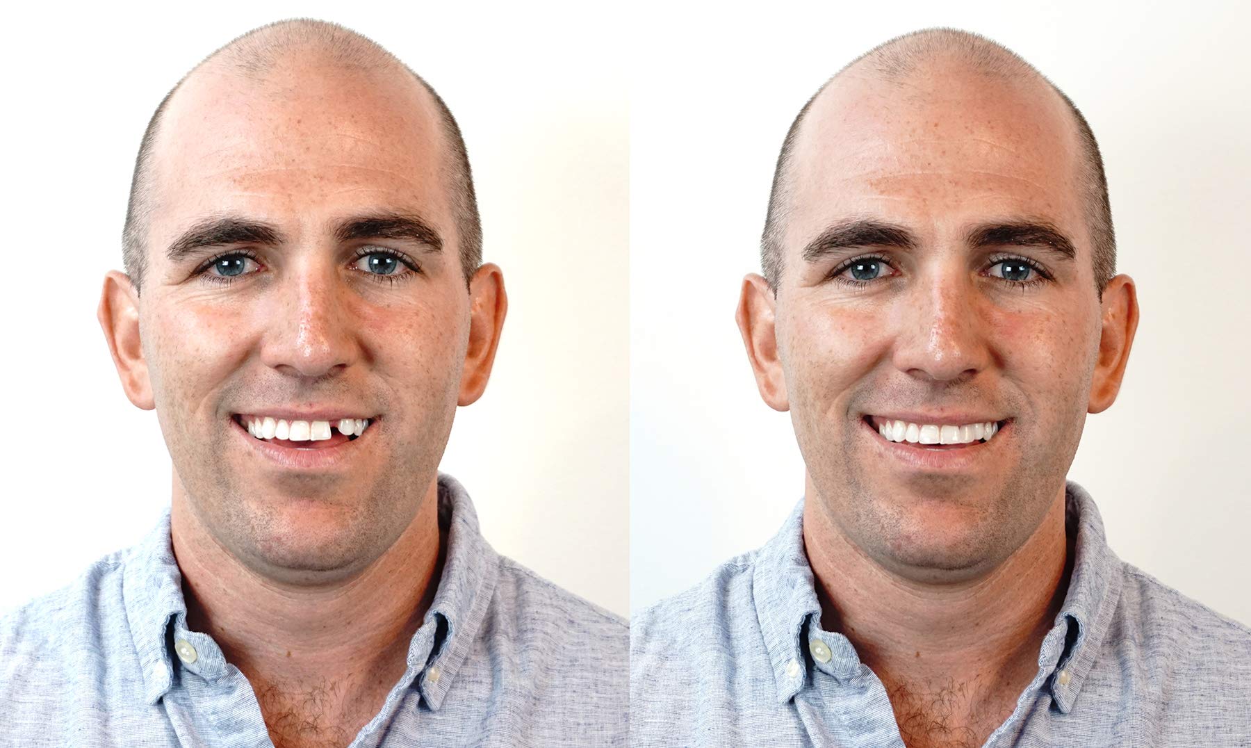 Instant Smile Triple Shade Temporary Tooth Kit - Replace A Missing Tooth in Just 5 Minutes!