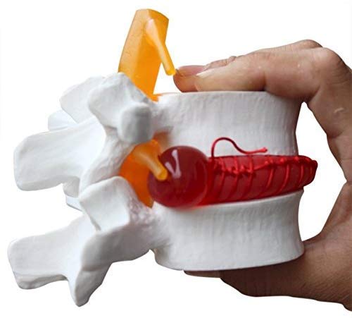 Doc.Royal Anatomical Human Lumbar Vertebrae Degenerative Lumbar Human Spine Model 1PCS