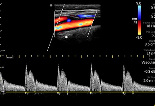 Philips FUS6882 Lumify L12-4 Linear Array Transducer, Portable Ultrasound Solution