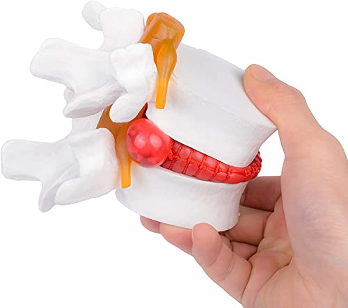 MIIRR Human Lumbar Disc Herniation Model, Vertebral Spine Anatomical Medical Model Perfect for Learning & Teaching Tool - Lumbar Vertebral Spine Model