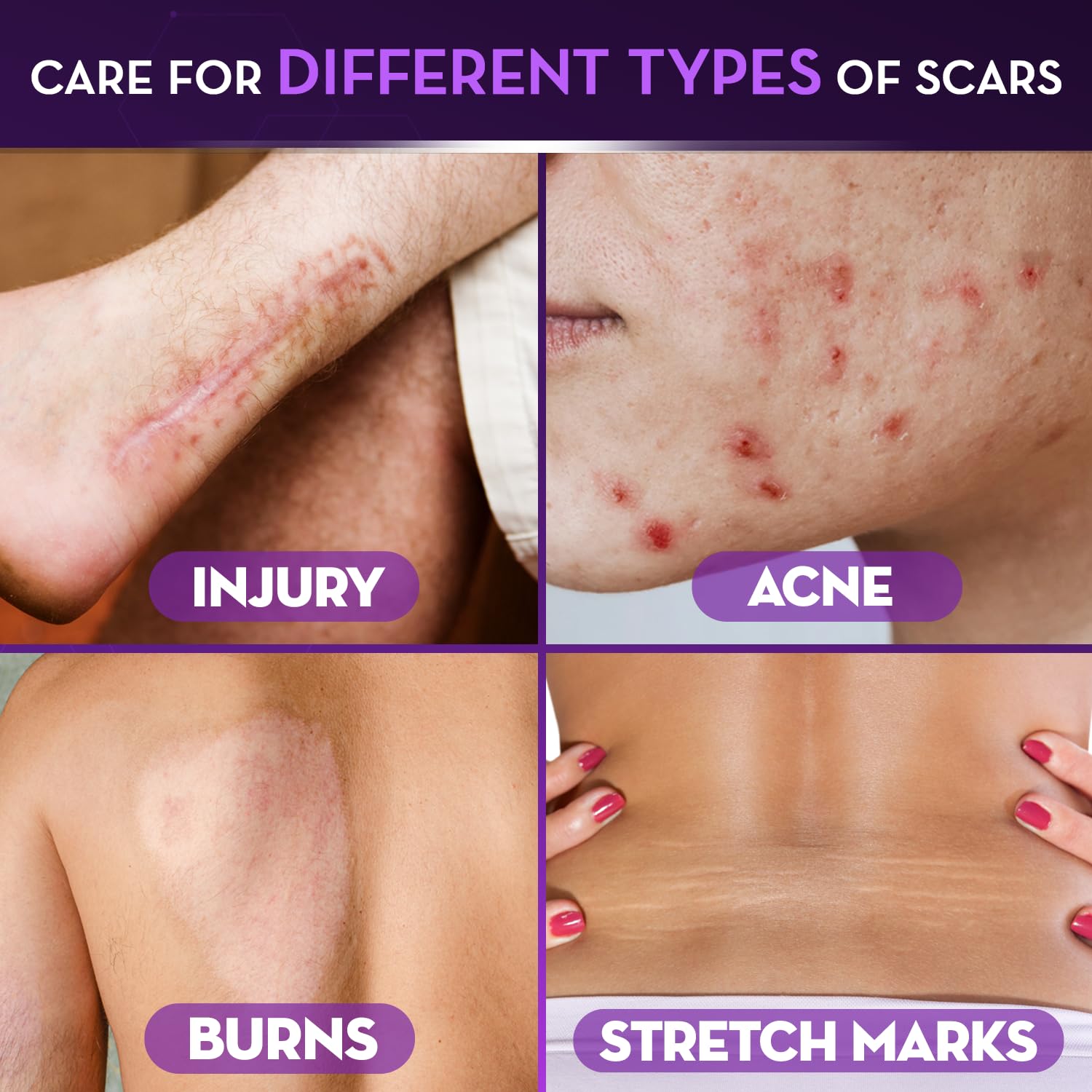 Cicatricure Scars Gel 1oz Tube Multipack Value Deal Pack of 3 Tubes