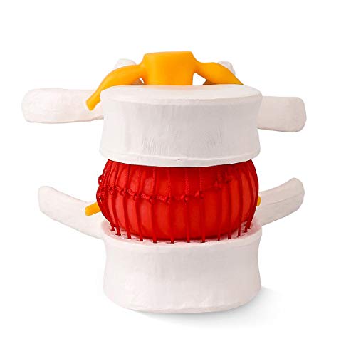 Human Anatomical Lumbar Disc Herniation Model - Lumbar Spine Model for Teaching & Learning - Excellent Way for Demonstrating Disc