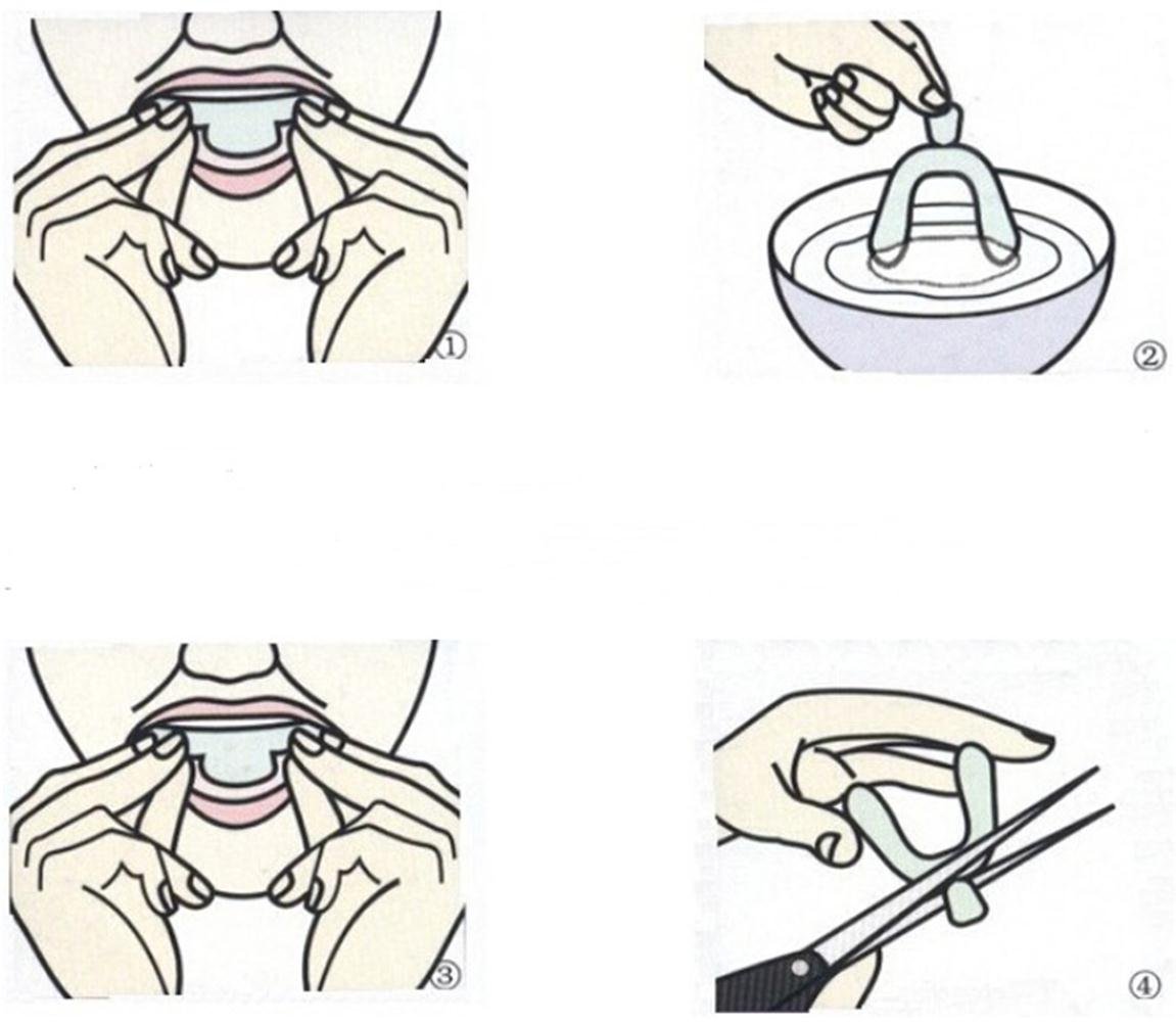 VECANCE 4PCS Transparent Silicone Thermoform Moldable Dental Mouth Guard, Whitening Teeth Trays Whitener Mouth Guard Care Oral Hygiene Bleaching Tooth Tool