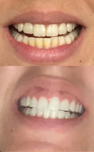 Smile Titan Teeth Whitening Kit, Teeth Whitening Gel (4) with 5X LED Accelerator Light and Tray Teeth Whitener