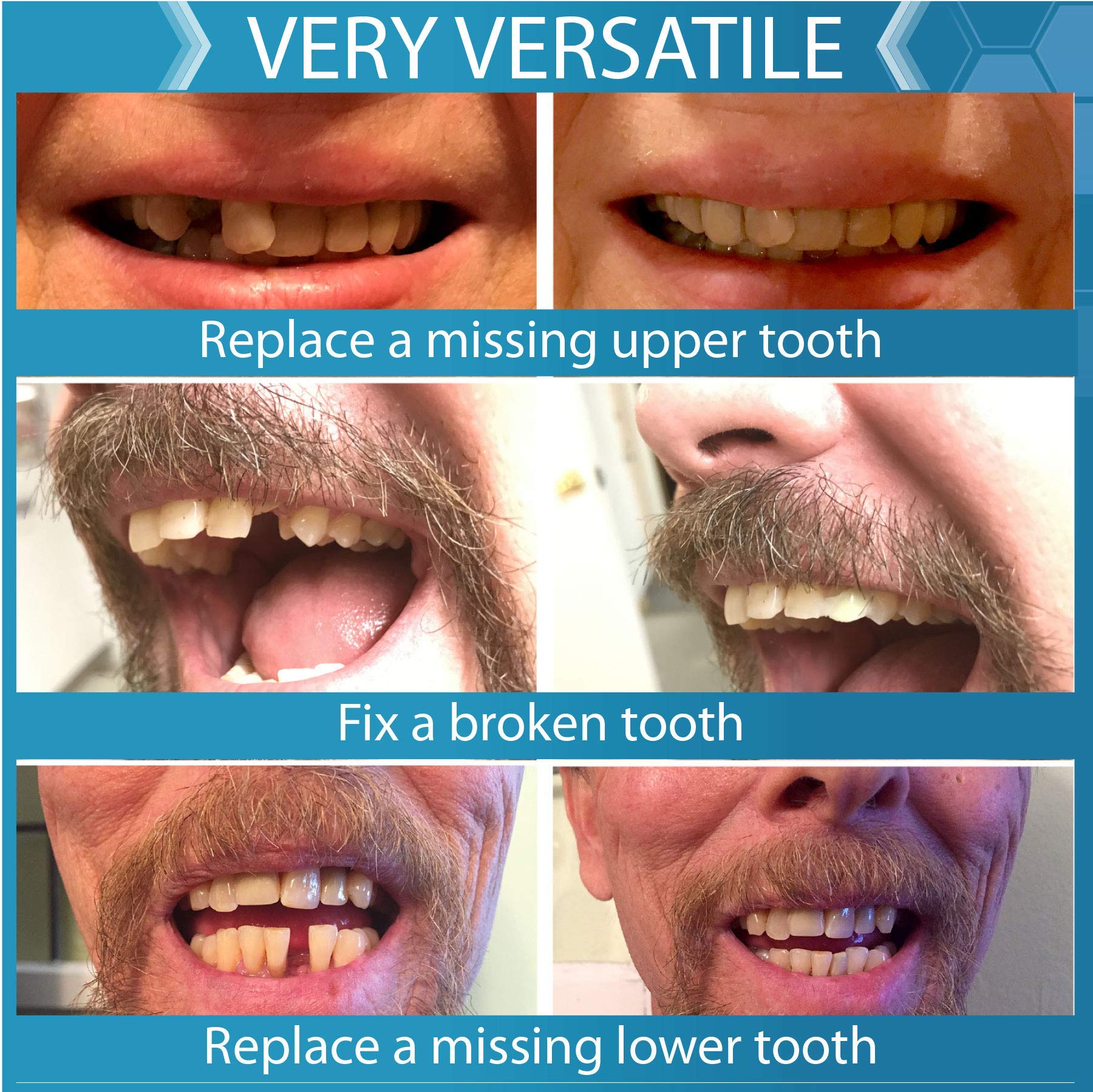 Instant Smile Complete Your Smile Tooth Replacement Kit with 3 Pack Fitting Beads