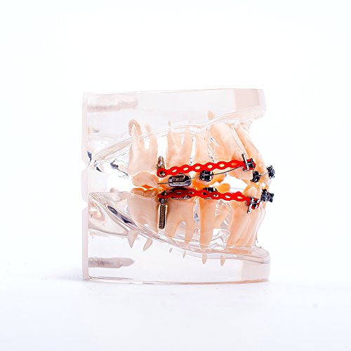 Easyinsmile Dental Orthodontic Treatment Model Teeth/Tooth/Denture Model with Braces for Dentist Studying Researching and Patient Education (Metal Bracket)