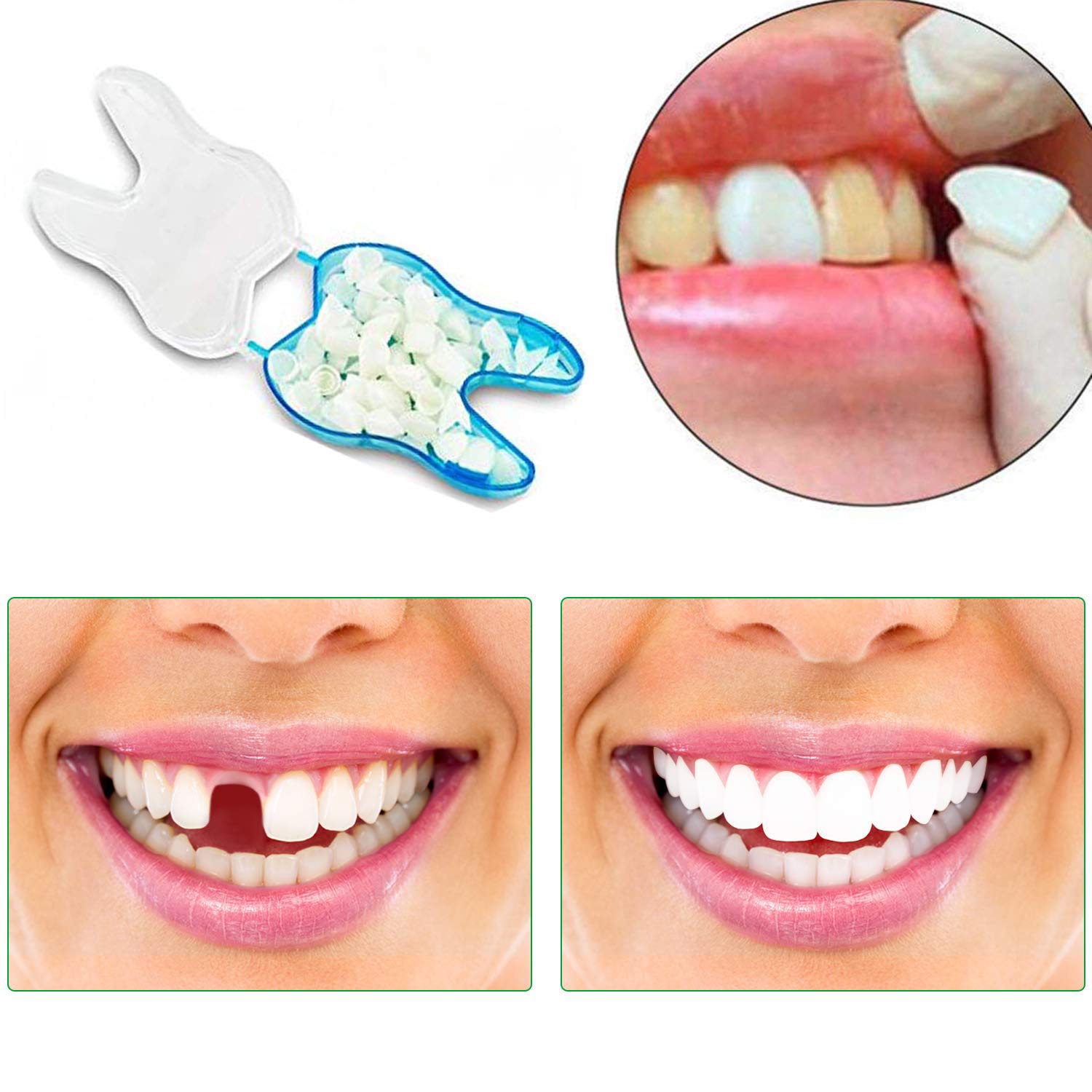 Temporary Tooth Crown Fake Teeth Repair Material Front & Molar Posterior offering Help in Fixing Missing Broken Tooth (2 boxes around 100 pcs)