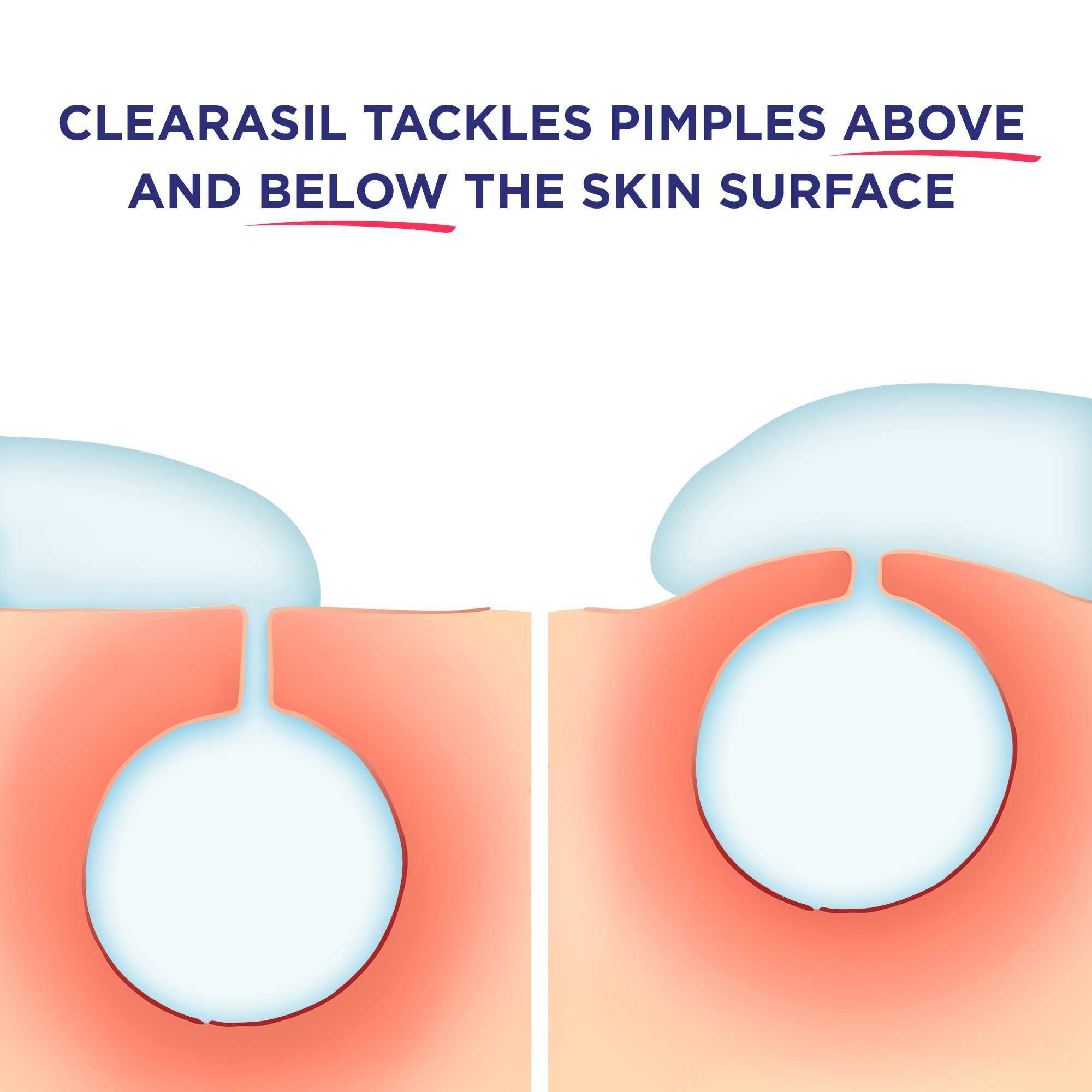 Clearasil Stubborn Acne Control 5 in 1 Spot Treatment Cream, Maximum Strength, Benzoyl Peroxide Acne Medication, Fights Blocked Pores, Pimple Size, Excess Oil, Acne Marks & Blackheads, 1 oz.