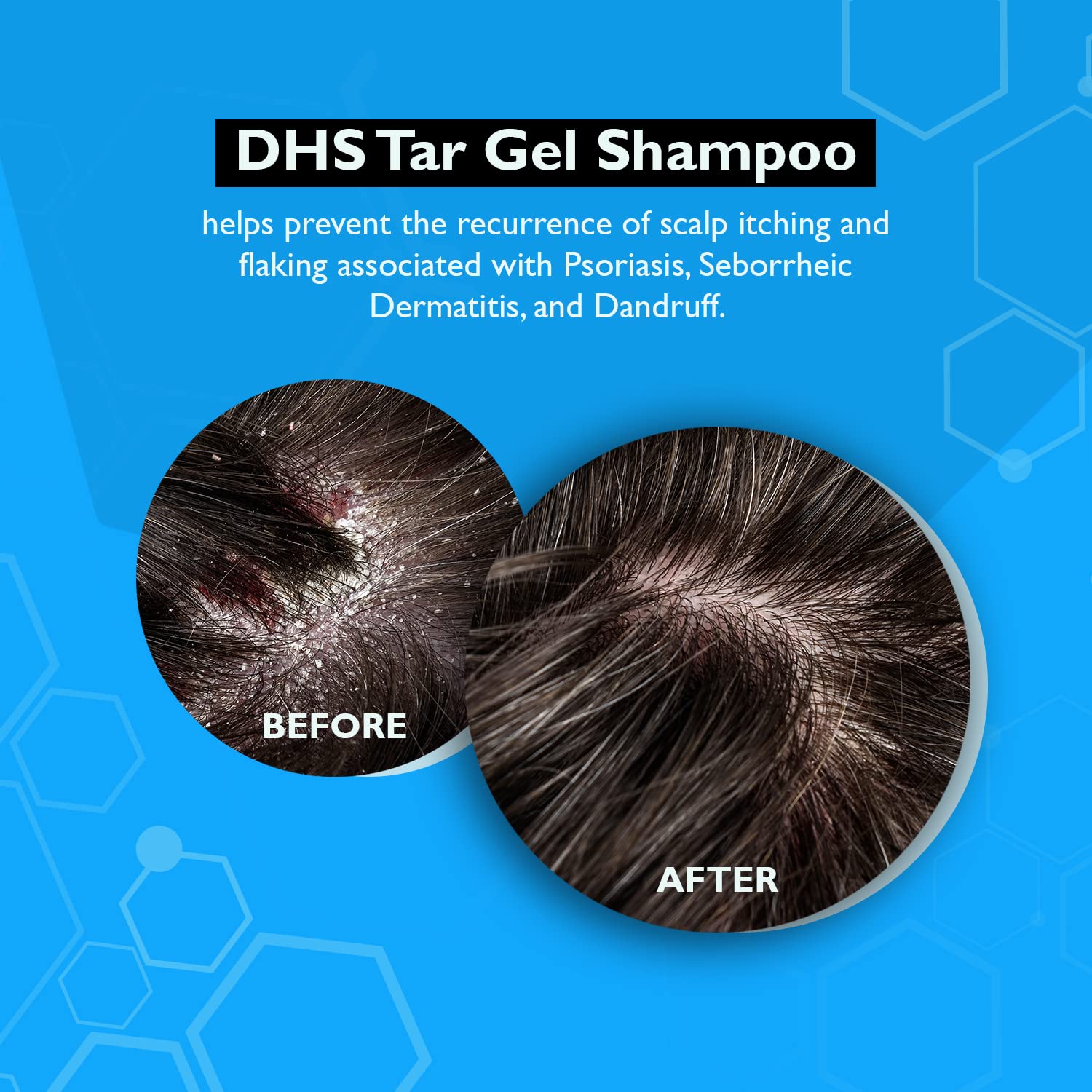 DHS Person & Covey T Gel Shampoo - Anti Dandruff Shampoo, Mildly Scented Psoriasis Shampoo - 8 Fl. Oz. - Refined Coal Tar Gel Formula, Scalp Psoriasis Shampoo, Deep Cleansing Rich Lather