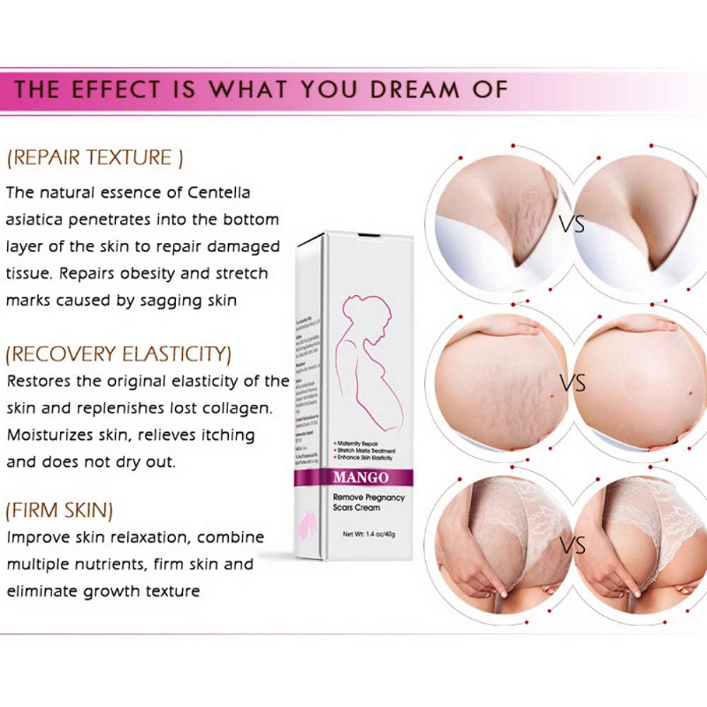 Stretch Mark Cream For Pregnancy Repair Scar Slack Line Abdomen Stretch Marks Cream, Remove Stretch Marks From Pregnancy, Repair Scar Slack Line Abdomen Stretch Marks Postpartum