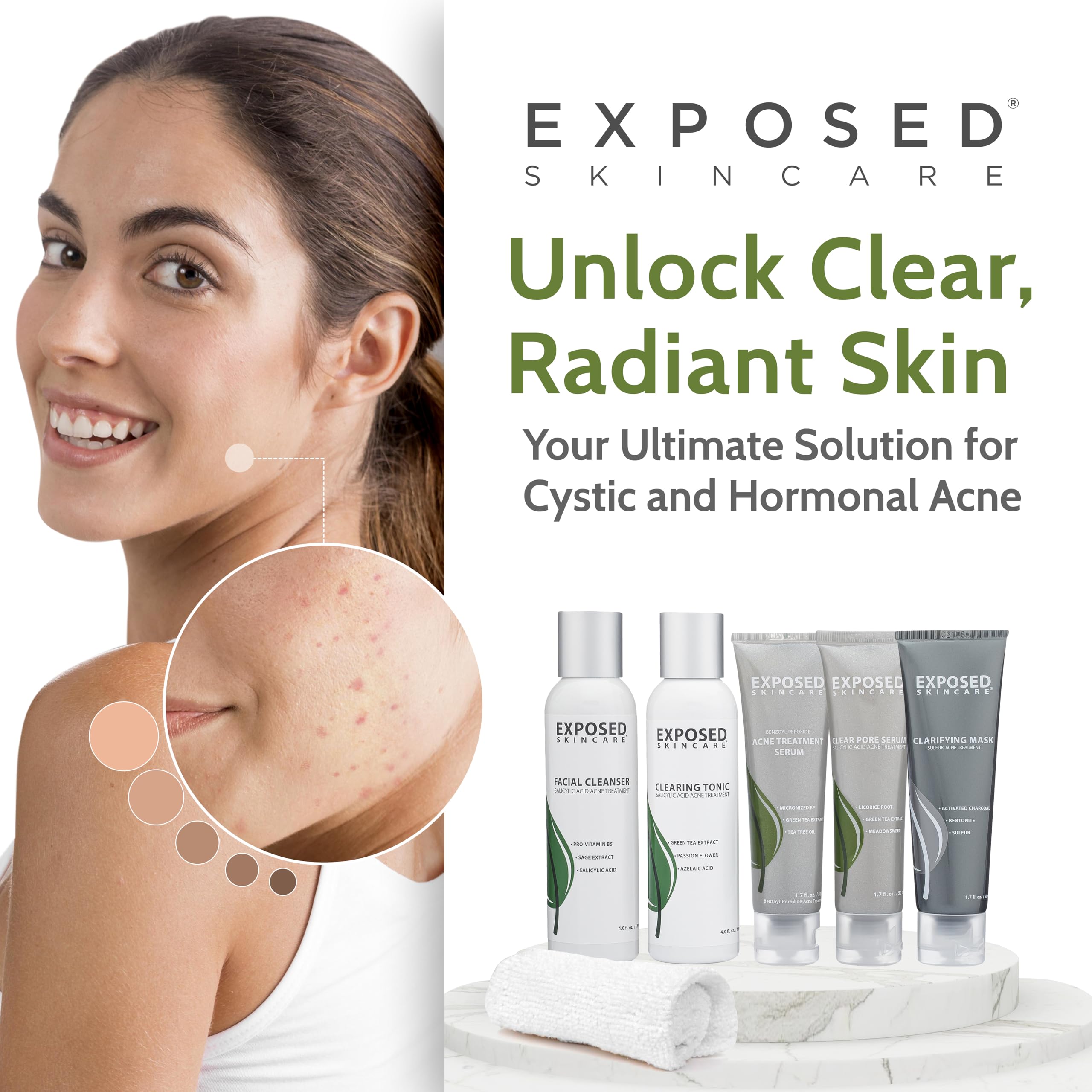 Exposed Skin Care Acne Treatment Kit - Includes Facial Cleanser, Clearing Tonic, Acne Treatment Serum, Clear Pore Serum, Clarifying Mask, Cloth - Natural Acne Solution for Face, All Ages & Skin Types