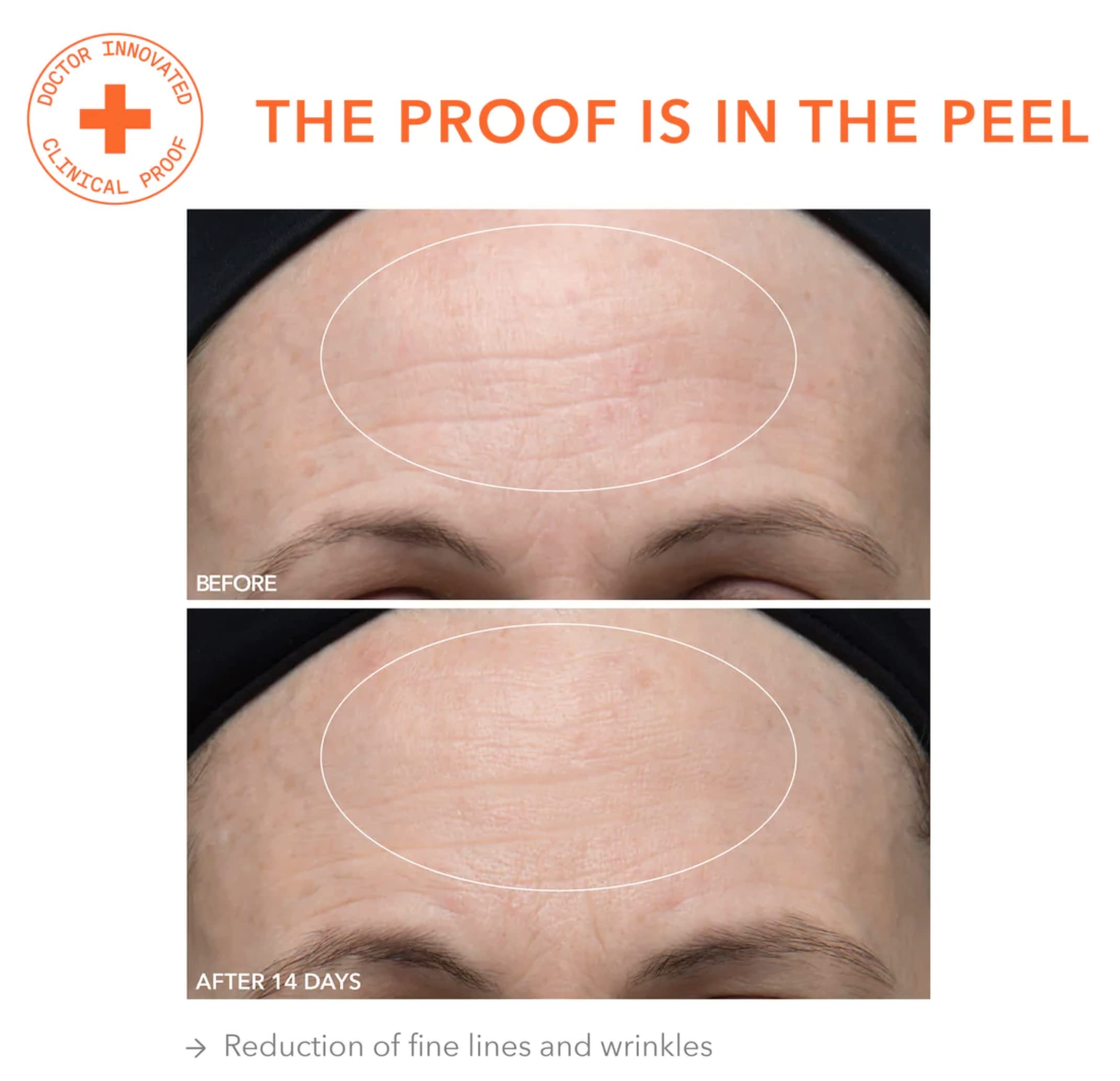 Dr. Dennis Gross Alpha Beta Ultra Gentle Daily Peel: for Dehydrated or Sensitive Skin, Uneven Tone or Texture, Fine Lines or Enlarged Pores (30 Treatments)