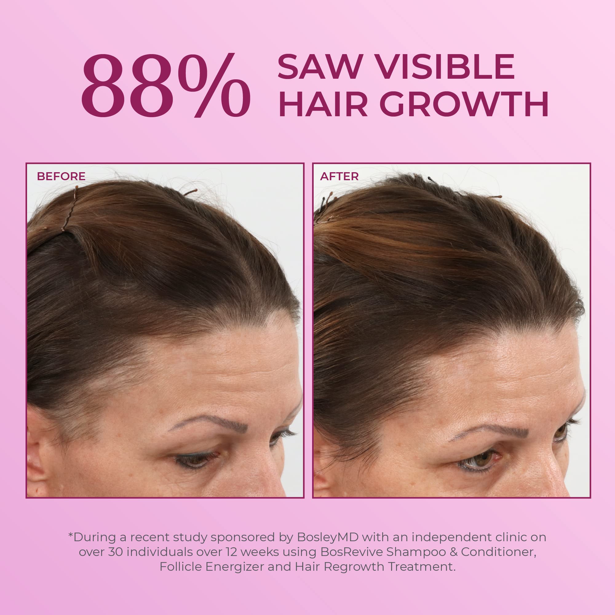 BosleyMD Hair Regrowth Treatment Regular Strength By for Women - 2 X 2 Oz Treatment, 2count