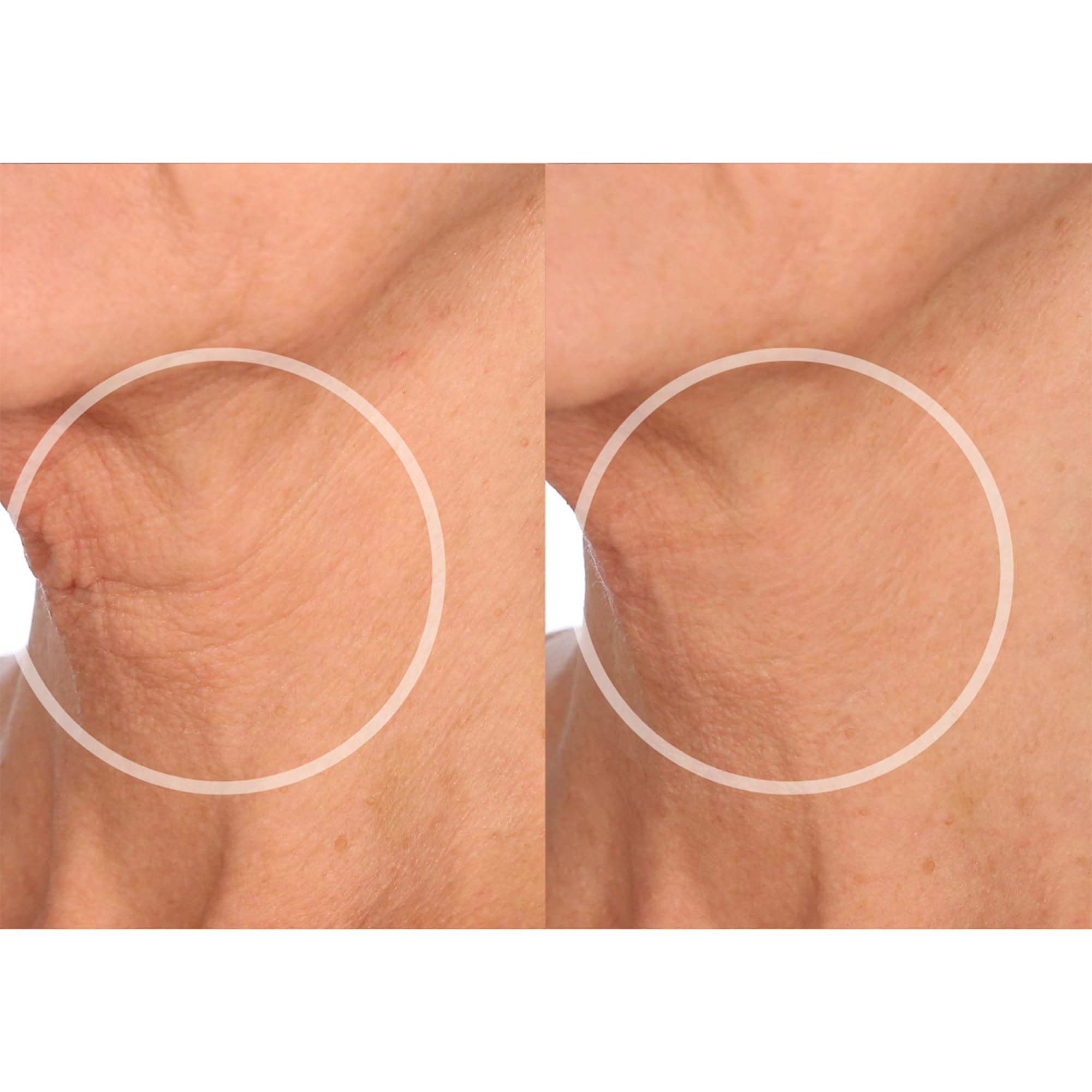 SiO Beauty FaceLift - Reusable Anti-Wrinkle Patches for Neck, Forehead, Eye & Smile - Overnight Smoothing Silicone for Fine Lines, Wrinkles, and Aging