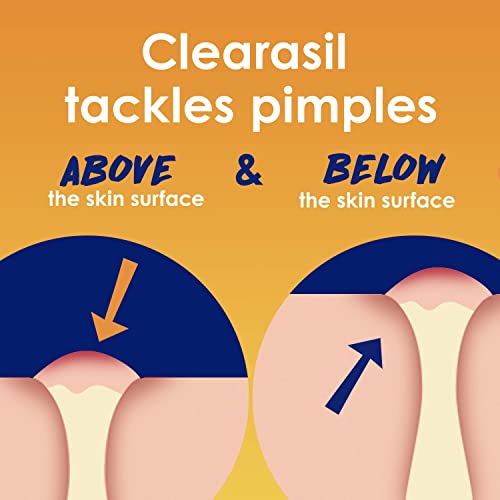 Clearasil Stubborn Acne Control 5-in-1 Spot Treatment Cream with Benzoyl Peroxide Acne Medication to Clear Acne, 1 Ounce (Pack of 3)
