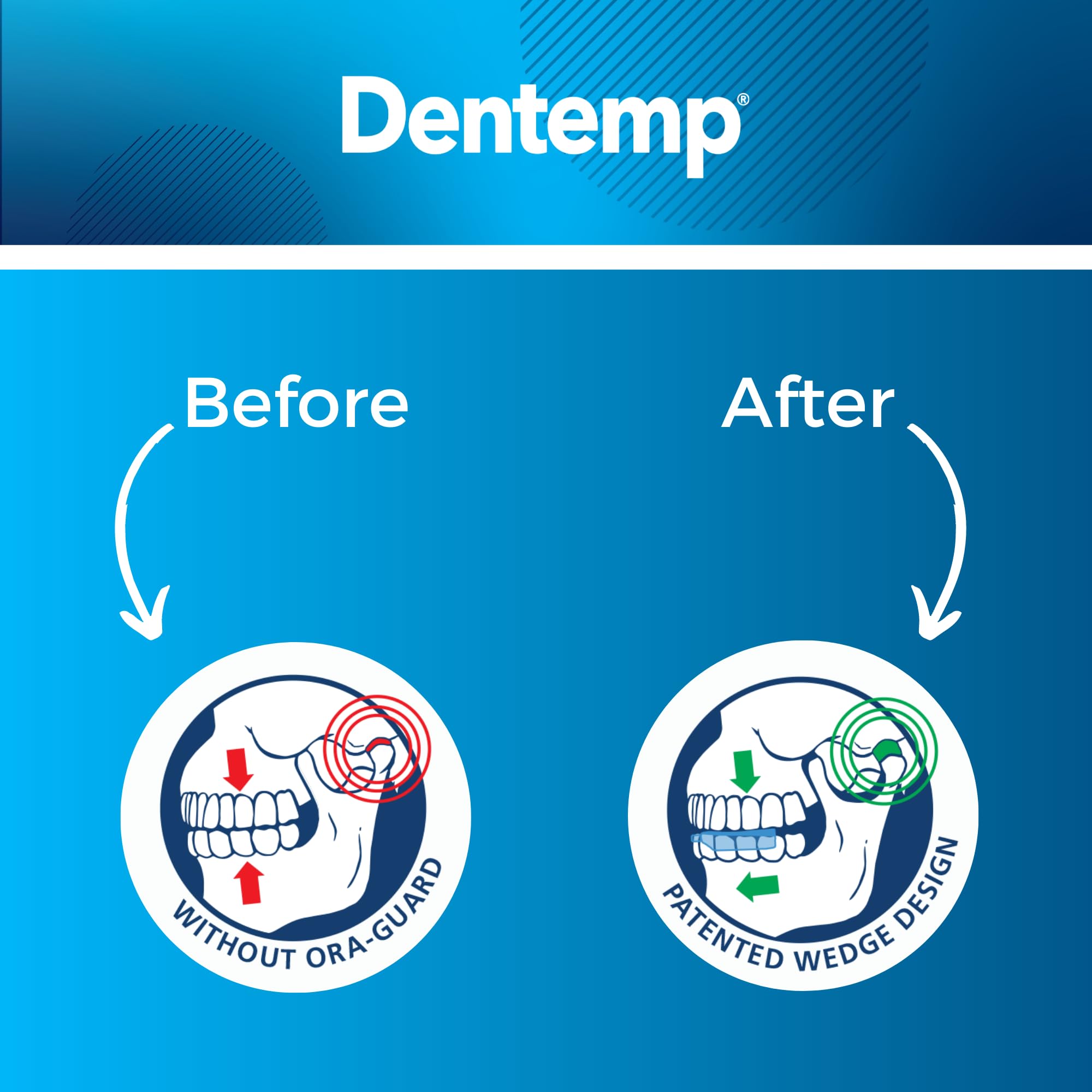 Dentemp Ora-Guard Custom Fit Dental Guard - Bruxism Night Guard for Teeth Grinding - Mouth Guard for Clenching Teeth at Night - Comfortable Mouth Guard for Sleeping - Relieve Soreness in Jaw Muscles…