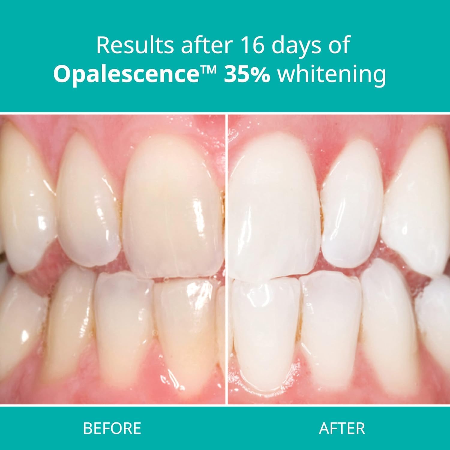 Opalescence 35% CP Mint - Gel Syringes Teeth Whitening - Refill Kit (2 Packs / 4 Syringes Total) Carbamide Peroxide Gel. Made by Ultradent. Tooth Whitening Refill Syringes 5197-2