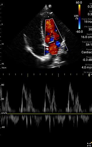 Philips Lumify S4-1 Phased Array Transducer, Portable Ultrasound Solution
