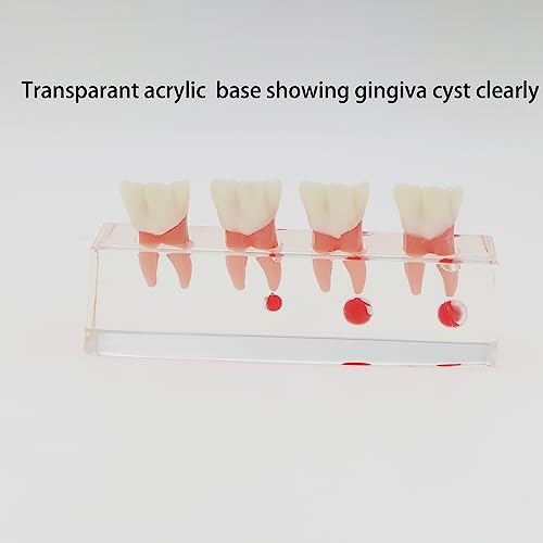 Dentalmall Dental 4-Stage Endodontic Treatment Model for Study Teach Teeth Model 4018 Root Canal Anatomy Demonstration Teaching Tooth Model