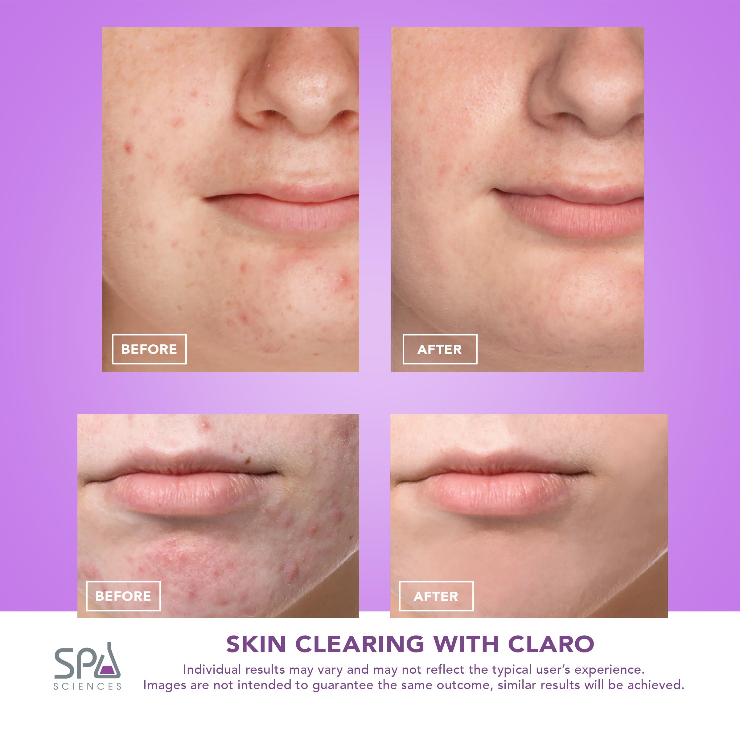 Spa Sciences CLARO Clinically Proven Blue & Red LED Acne Treatment Light Therapy System-FDA Cleared-Rechargeable- Professional Home Acne Healing/Clearing Treatment