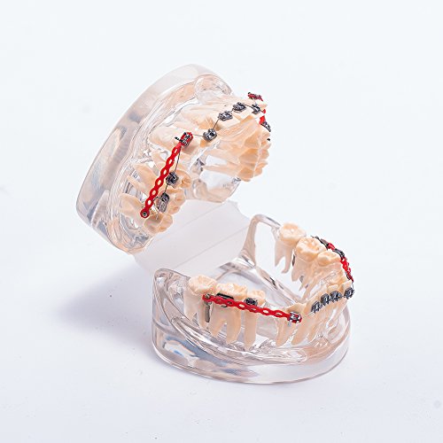 Easyinsmile Dental Orthodontic Treatment Model Teeth/Tooth/Denture Model with Braces for Dentist Studying Researching and Patient Education (Metal Bracket)