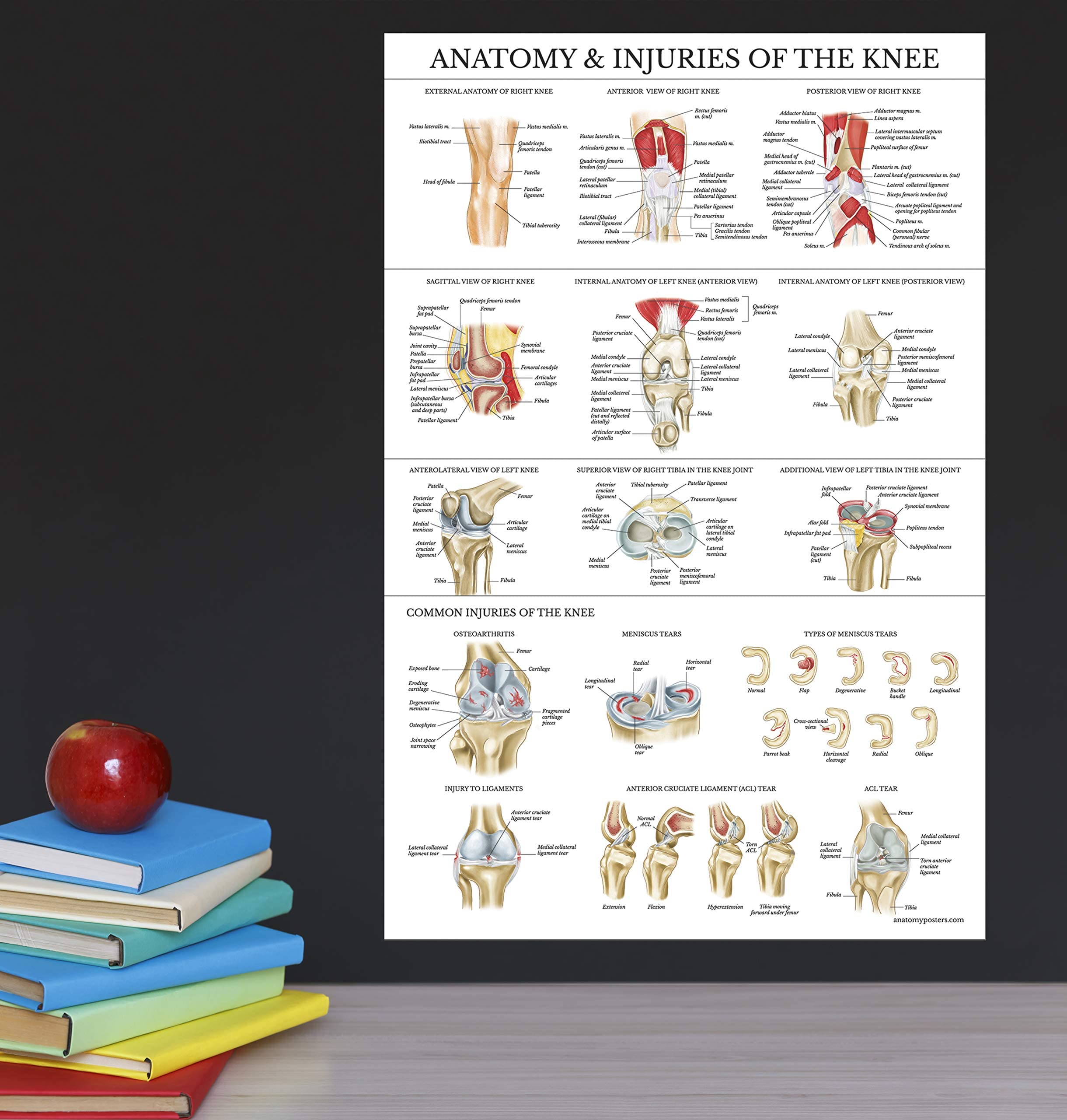 Palace Learning Laminated Anatomy and Injuries of the Knee Poster - Knee Joint Anatomical Chart - 18" x 24"