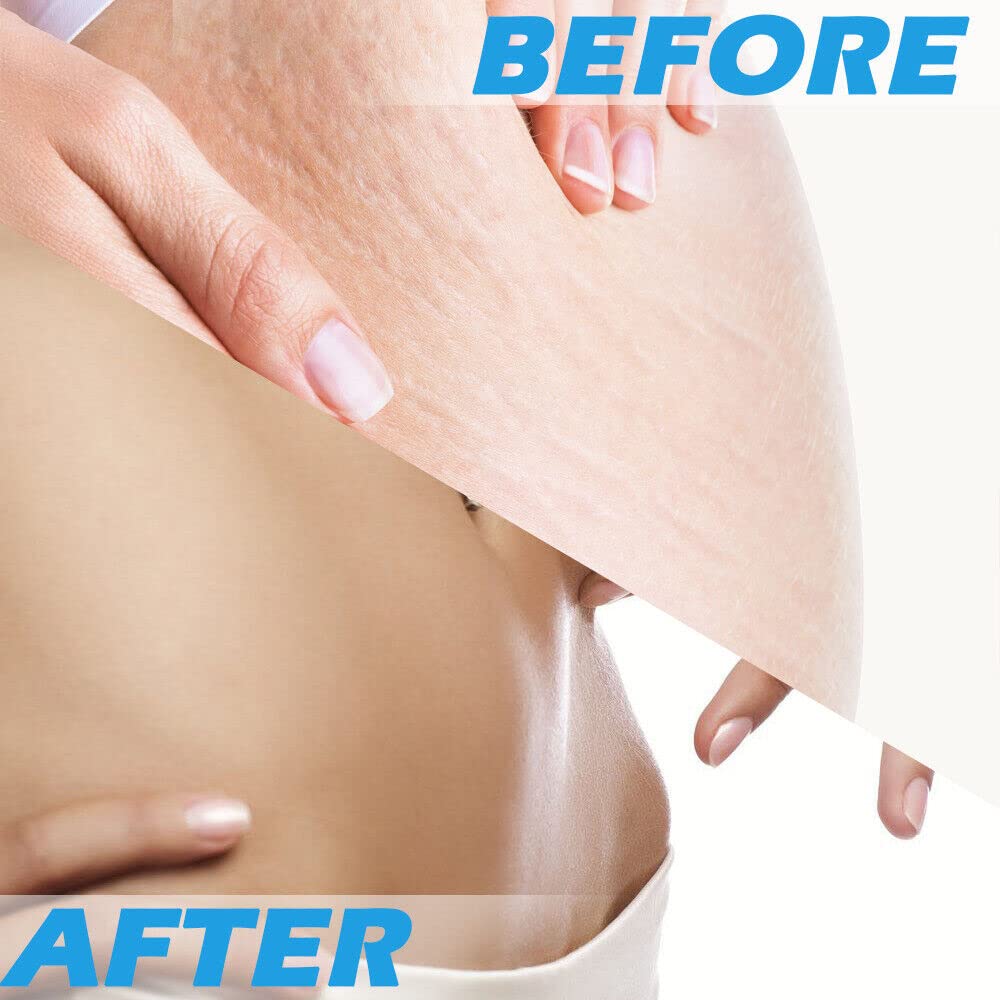 Alvarado Stretch Mark Repairing Cream. Pregnancy Marks & Scars Removal. 4 Oz