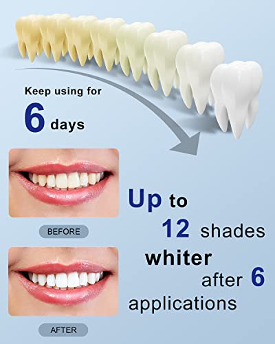 MySmile Teeth Whitening Kit with LED Light, 3 Non-Sensitive Teeth Whitening Gel and Tray, Deluxe 10 Min Fast-Result Carbamide Peroxide Teeth Whitener, Help Remove Teeth Stain from Coffee