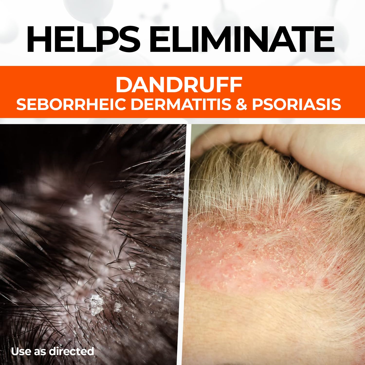 Medicasp Coal Tar Gel Dandruff Shampoo to Treat Seborrheic Dermatitis Psoriasis 3 Pack 6 oz