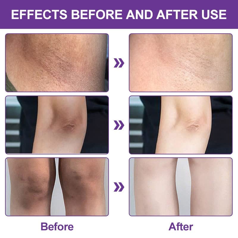 Acclyd Dark Spot Corrector Skin Lightening Cream for Body, Intimate Areas, Underarms, Armpit, Knees, Legs, Elbows and Inner Thigh, Whitening Cream Dark Spot Remover for Sensitive Areas (1.76 Fl Oz)