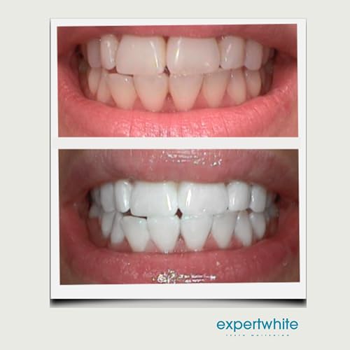 Expertwhite Teeth Whitening Gel Refills (6-gels). Made USA. 44 percent Carbamide Peroxide Tooth Bleaching Gel bleach For Invisalign style trays, Dental Grade Tooth Whitener. 6 syringes