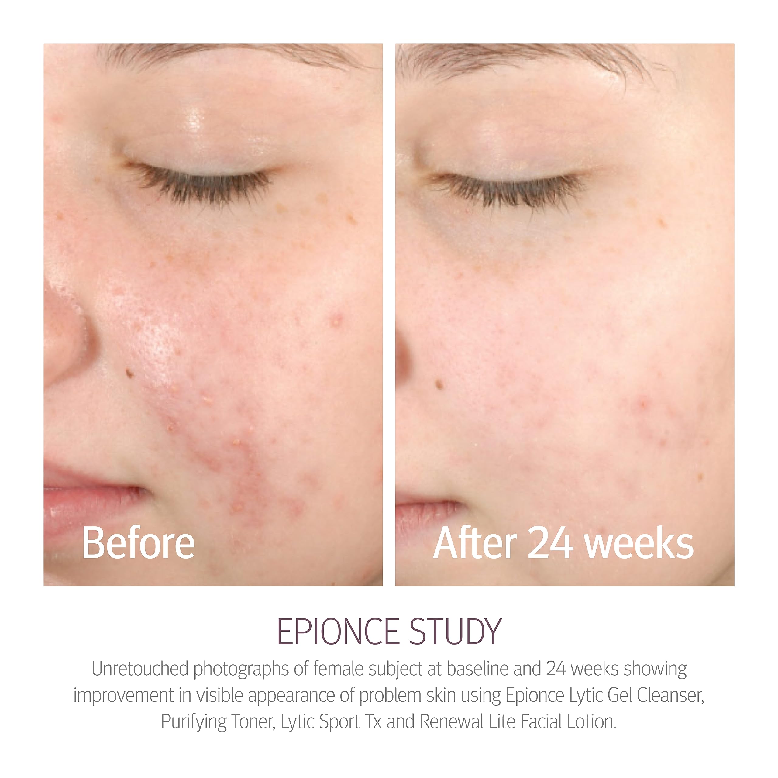 Epionce Purifying Toner - Facial & Body Toner for Problem Skin, Cleanses Dirt, Oil & Makeup with Willow Bark, Cucumber & Menthol, Dermatologist Skincare