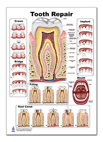 Tooth Repair Poster, Chart (PVC, Large 24x36)