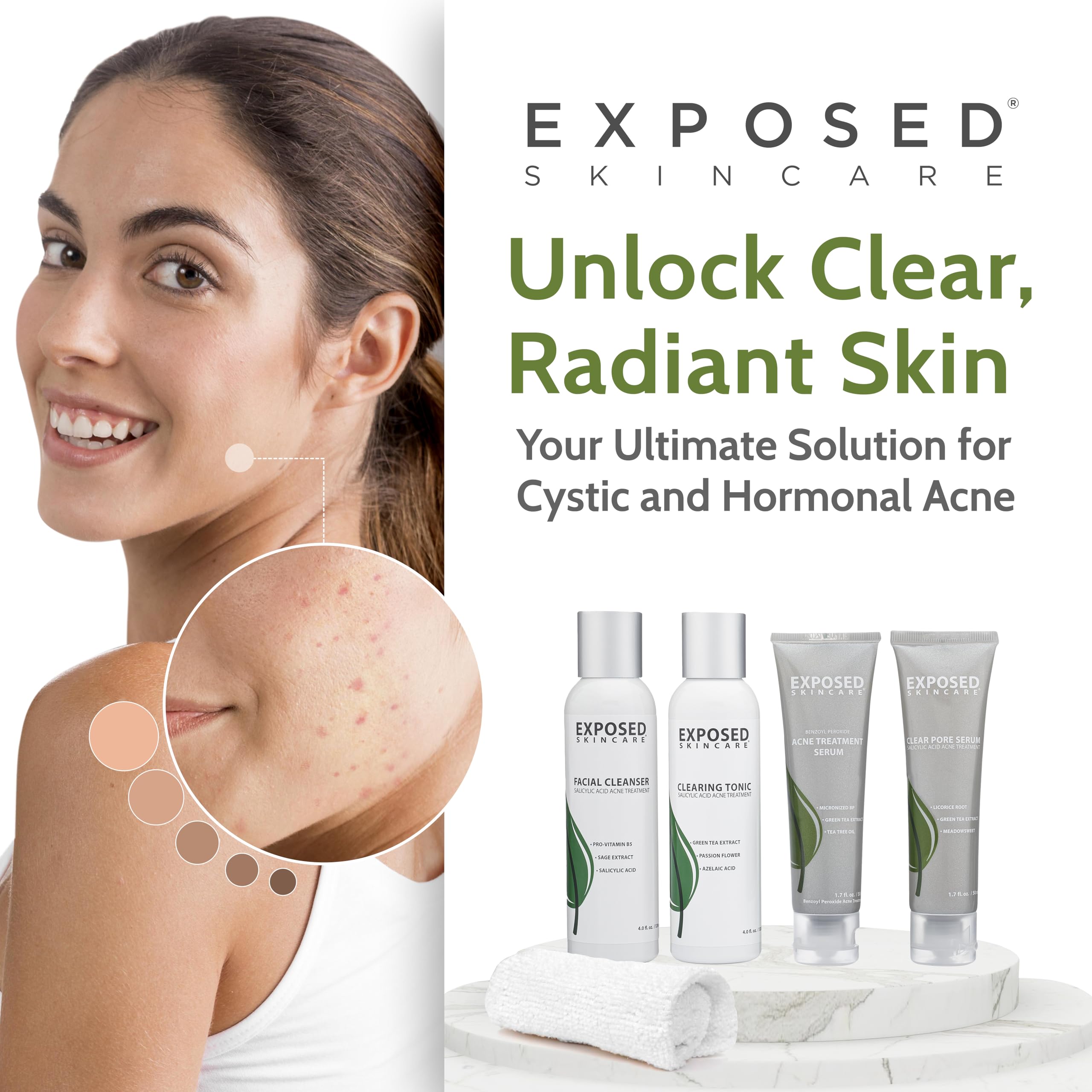 Exposed Skin Care Basic Acne Treatment Kit - Includes Salicylic Acid Face Wash, Clearing Tonic, Acne Treatment Serum with Benzoyl Peroxide, Clear Pore Serum - Acne Set Solution for All Skin Types