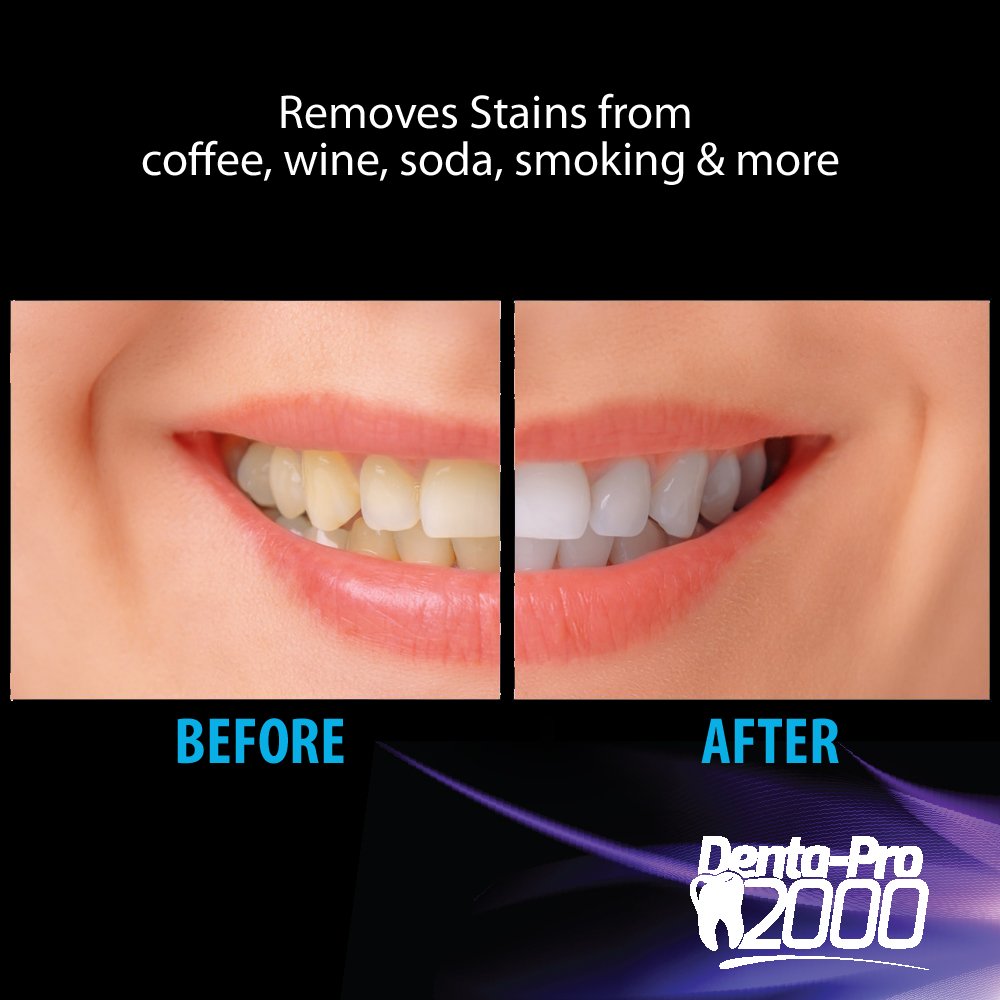 Teeth Whitening Kit - Professional At Home Teeth Whitening - Denta-Pro2000 It's Safe & Affordable - Get Whiter Teeth After Just One Use!