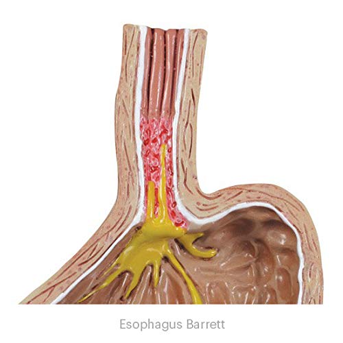 GPI Anatomicals - 4-Piece Stomach Model Set with Gastroesophageal Reflux Disease (GERD), Replica for Human Anatomy and Physiology Education, Anatomy Model for Doctor's Offices, Medical Study Supplies