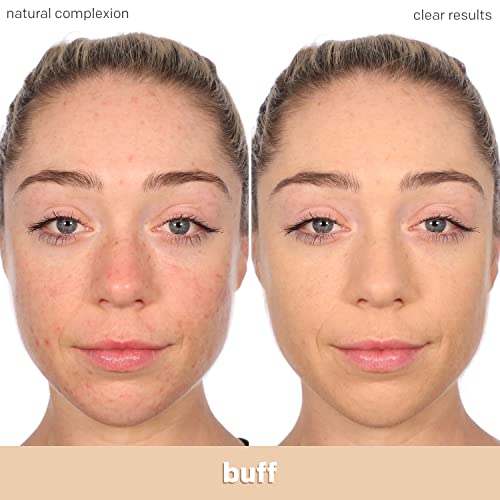Almay Clear Complexion Acne Foundation Makeup with Salicylic Acid - Lightweight, Medium Coverage, Hypoallergenic, -Fragrance Free, for Sensitive Skin , 200 Buff, 1 fl oz.