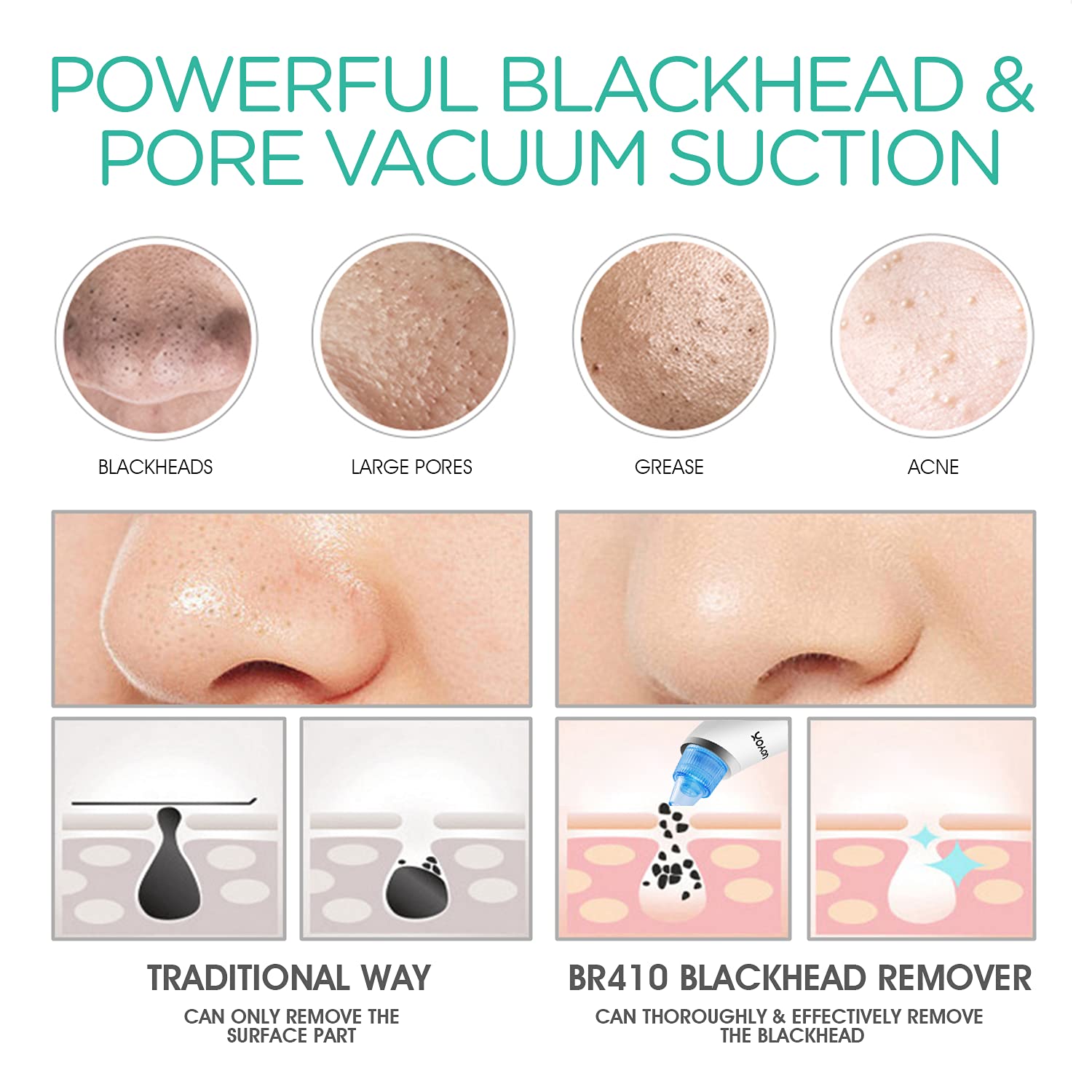 VOYOR Blackhead Remover Pore Vacuum - Electric Face Vacuum Pore Cleaner Acne White Heads Removal with 6 Suction Heads (BR410)
