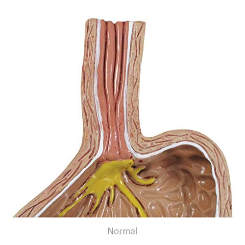 GPI Anatomicals - 4-Piece Stomach Model Set with Gastroesophageal Reflux Disease (GERD), Replica for Human Anatomy and Physiology Education, Anatomy Model for Doctor's Offices, Medical Study Supplies