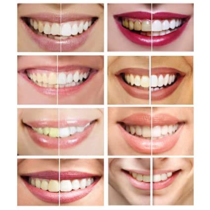 Remineralization Gel Reduces Teeth Sensitivity and Remineralizing After Teeth Whitening Treatment (3, 3ml)