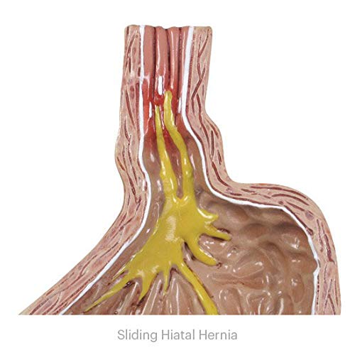 GPI Anatomicals - 4-Piece Stomach Model Set with Gastroesophageal Reflux Disease (GERD), Replica for Human Anatomy and Physiology Education, Anatomy Model for Doctor's Offices, Medical Study Supplies