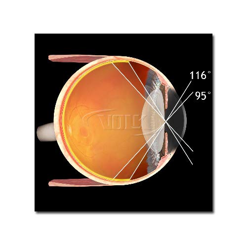 Volk SuperField NC Slit Lamp Lens - Red