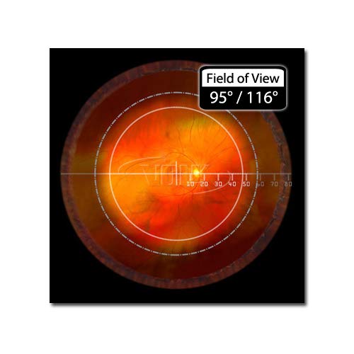 Volk SuperField NC Slit Lamp Lens - Purple