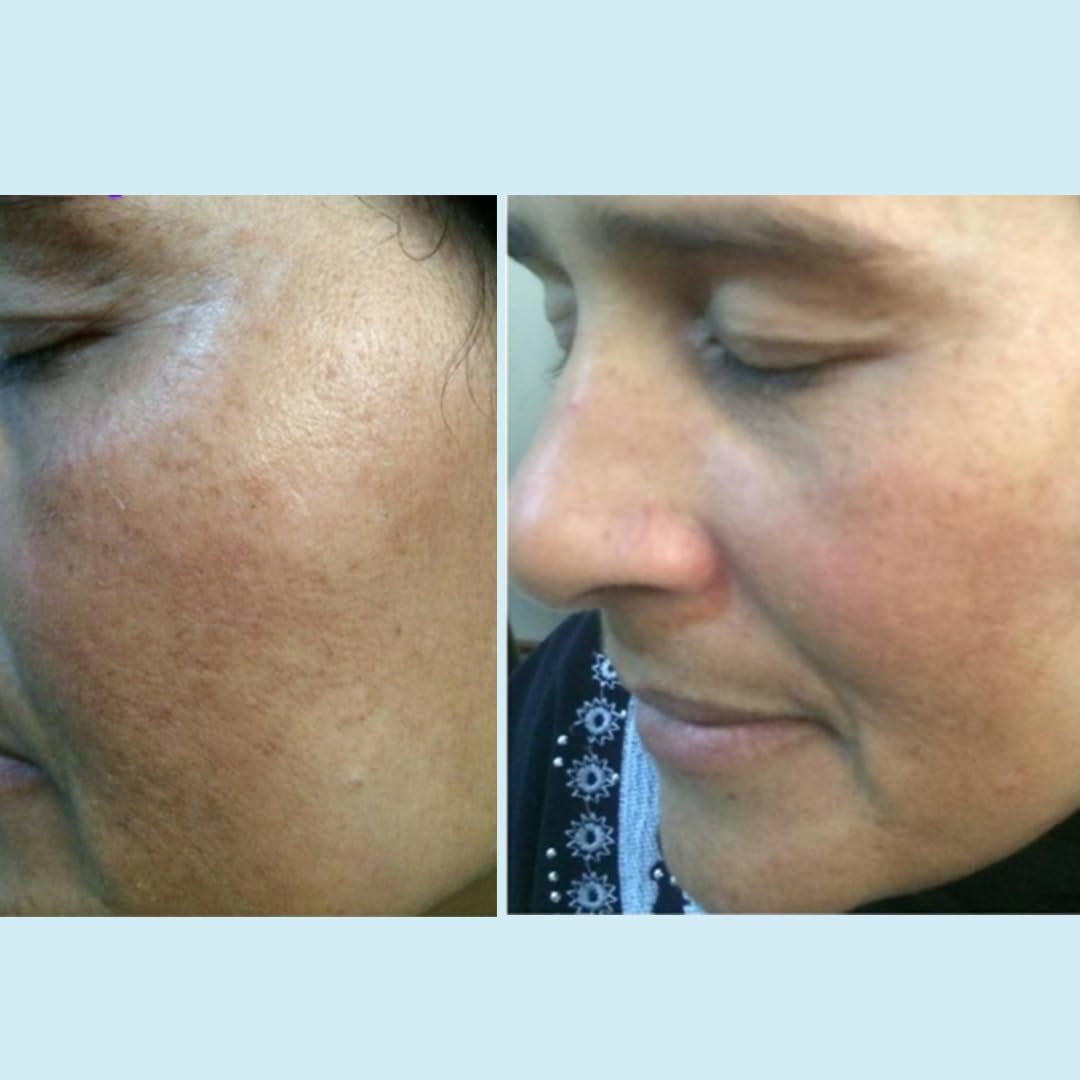 Lactic 50% Gel Peel, Chemical Peels for Face Breakout Scars, Chemical Exfoliant for Face, Strength Level 2, 1.0 fl oz. e, 30 mL – Perfect Image