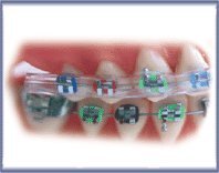 Morgan Bumper Braces Cover Lip Protector Qty 2 - Clear